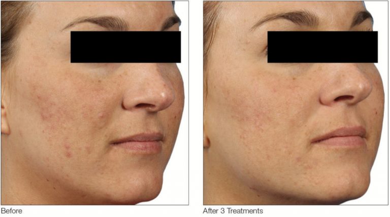 Venus Viva Treatments by Elysia in Tansor Oundle Peterborough | Elysia